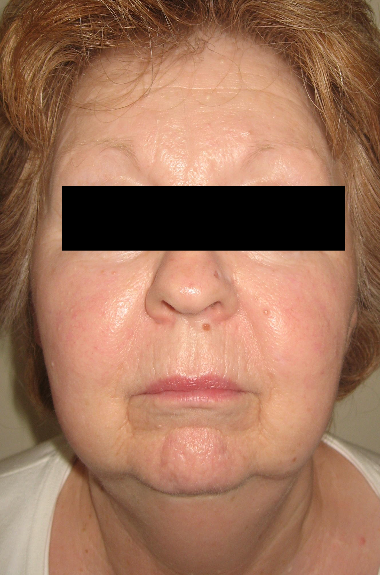 Platysmaplasty Surgery & Procedure | UK Aesthetic