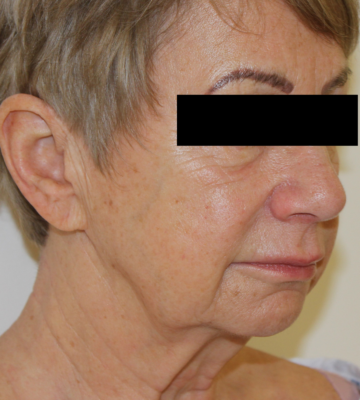 Fat Transfer To Face - Fat Transfer Under Eyes | UK Aesthetic