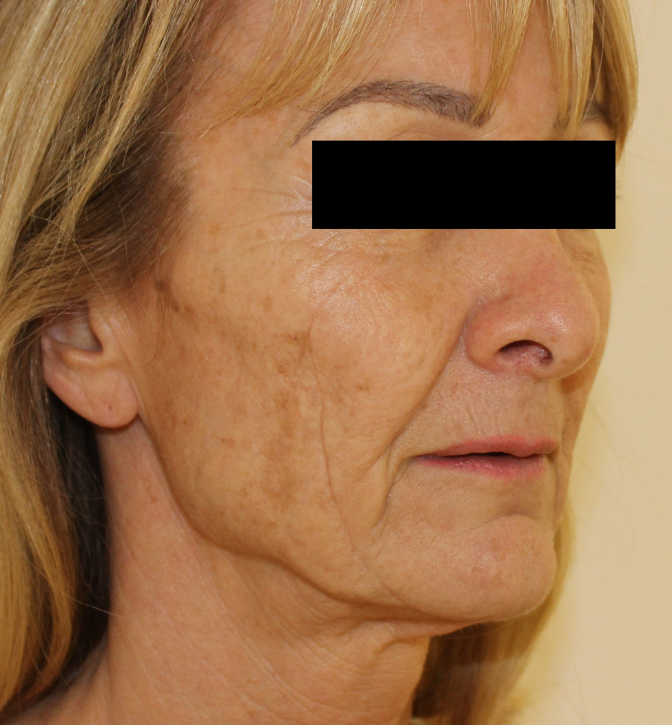 Platysmaplasty Surgery & Procedure | UK Aesthetic